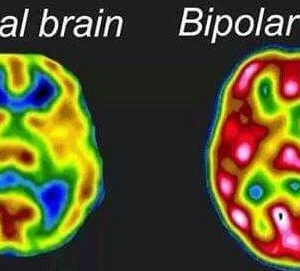 normal-brain-vs-bipolar-brain - TechSlack